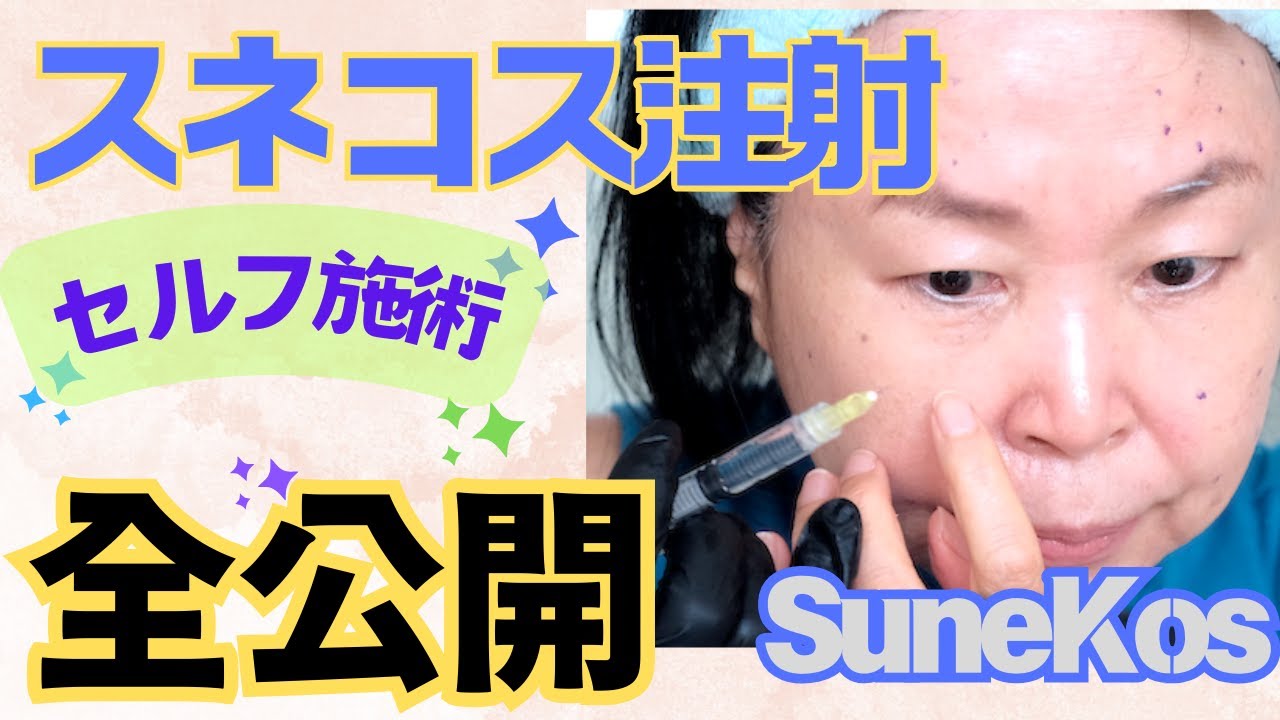 [全公開]スネコス注射のセルフ施術 Sunekos Self Injection Uncovered by Bi-ing-home - YouTube