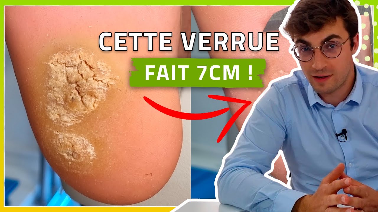 La plus GROSSE VERRUE (au MONDE) ? Traitement au Vercid - YouTube