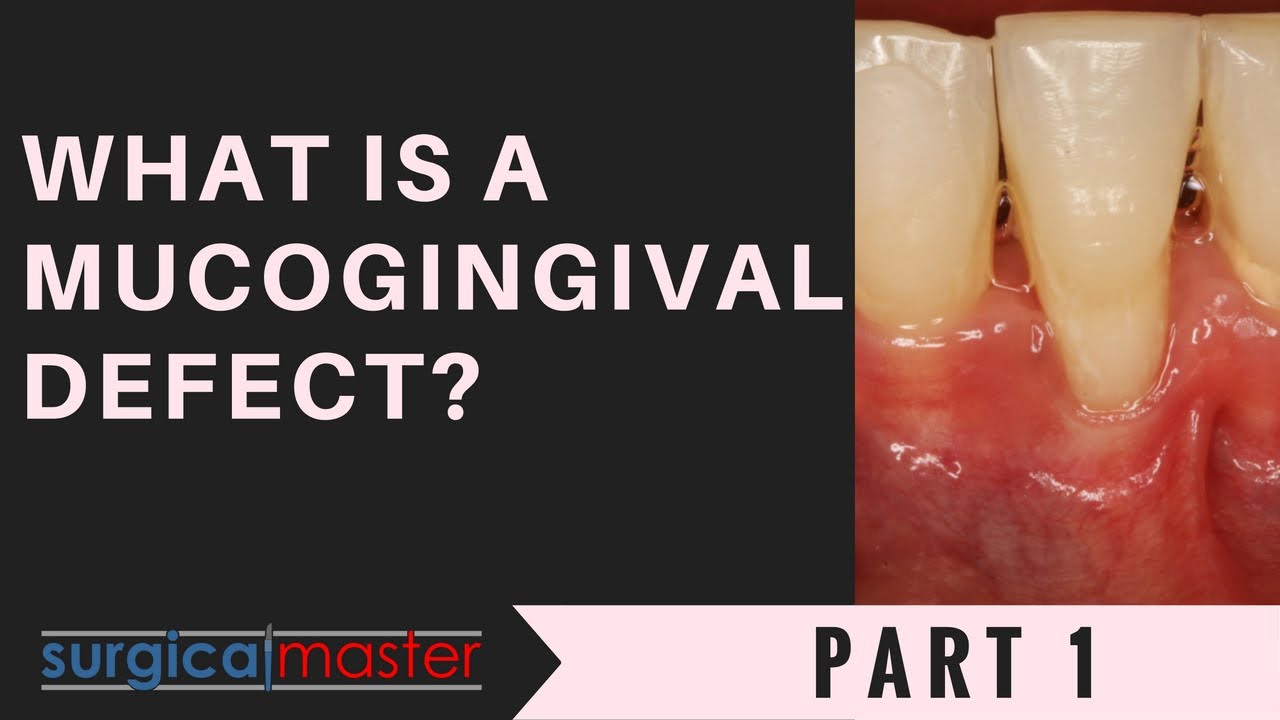 What is a MUCOGINGIVAL defect? PART 2 - YouTube