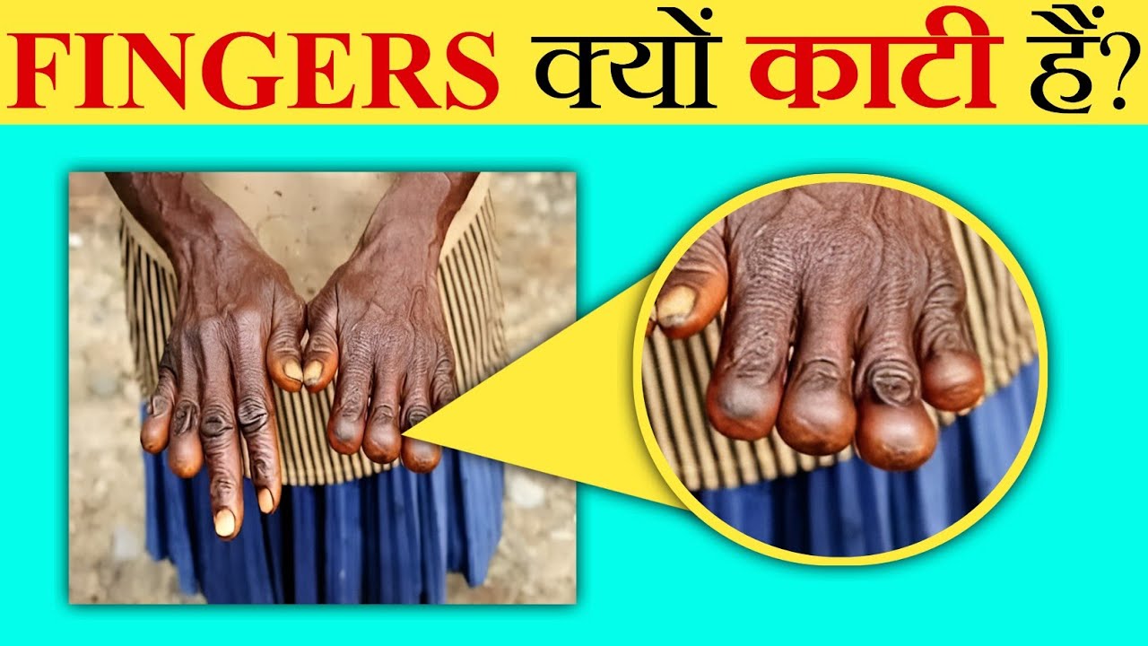 इनकी FINGERS क्यों कटी हैं? | People With Half Cut Fingers | Random ...