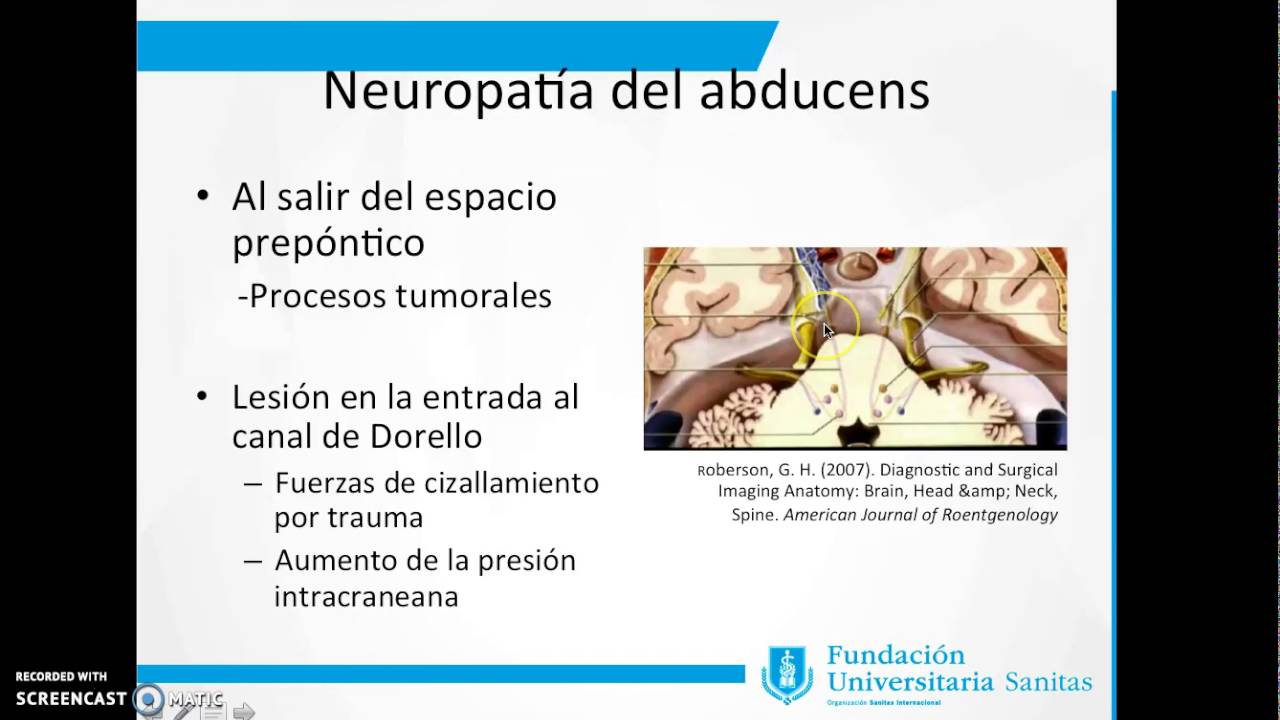 Lesión del nervio abducens - YouTube