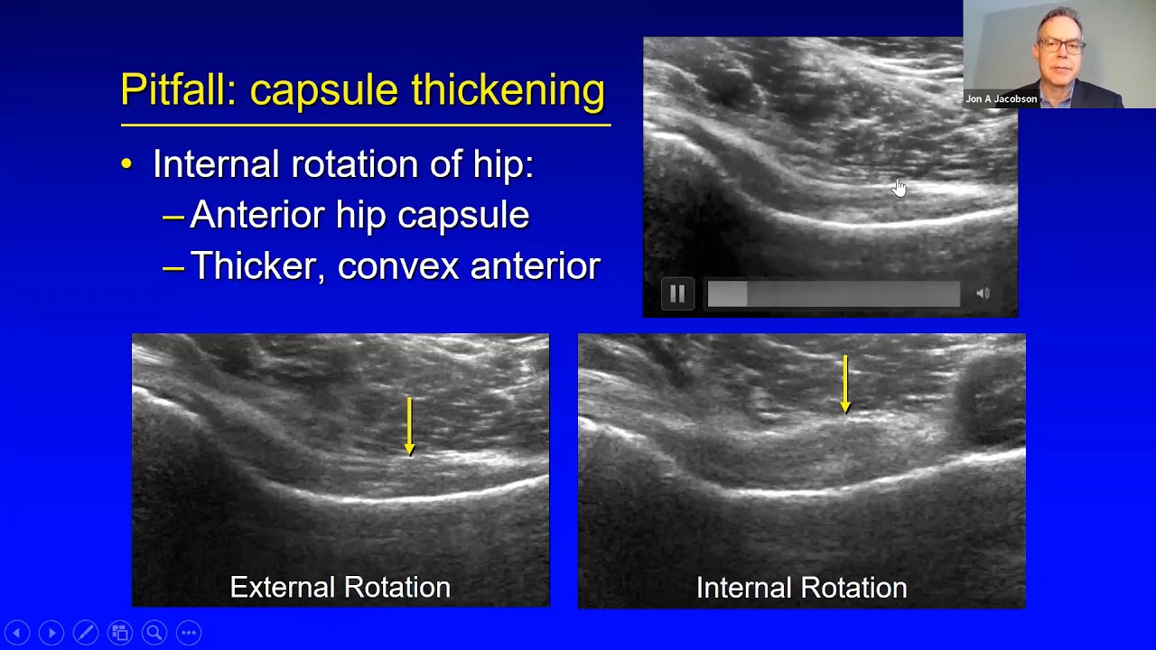 Dr. Jon Jacobson talks about US of Hip Pathology - YouTube
