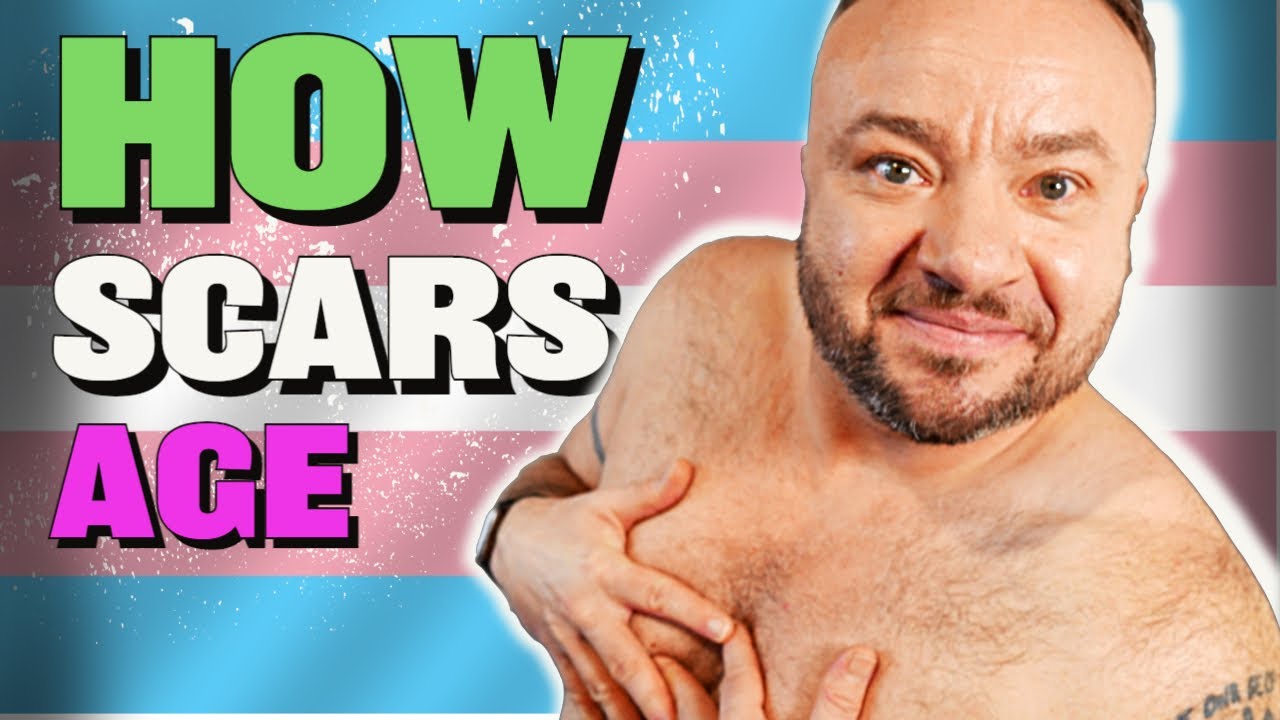 Top Surgery Ageing and Scars at 8 Years Post -Op - YouTube