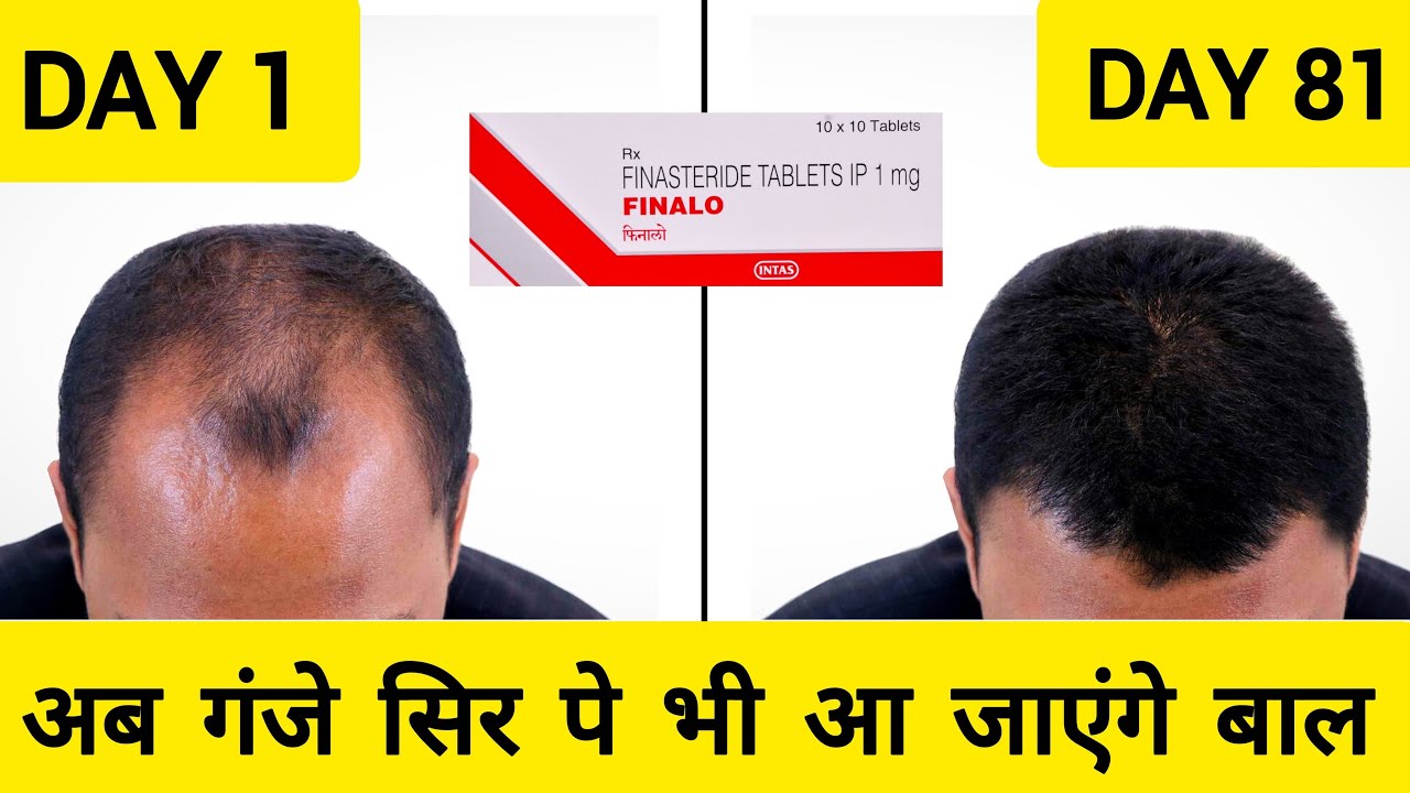 Finasteride 1mg Review | Finalo Tablet | Finasteride 1mg Results ...