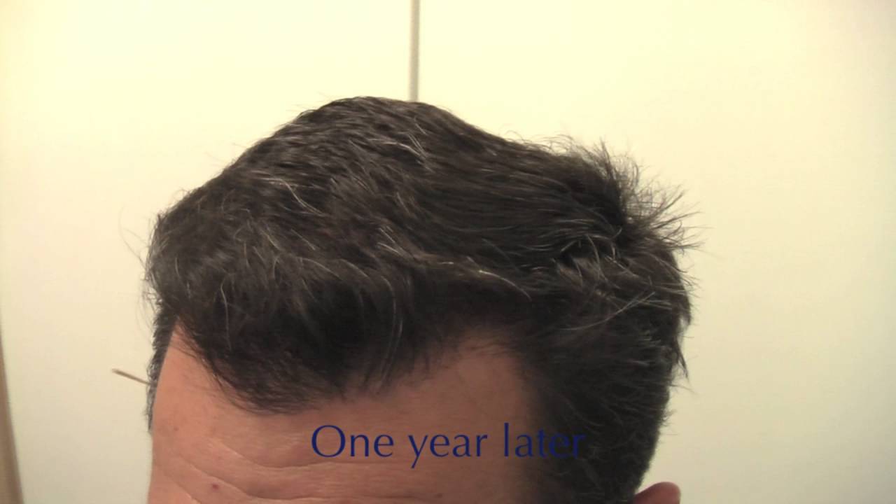 Frontal Fullness. High-Definition Hairline with 2343 grafts. Carlos K ...