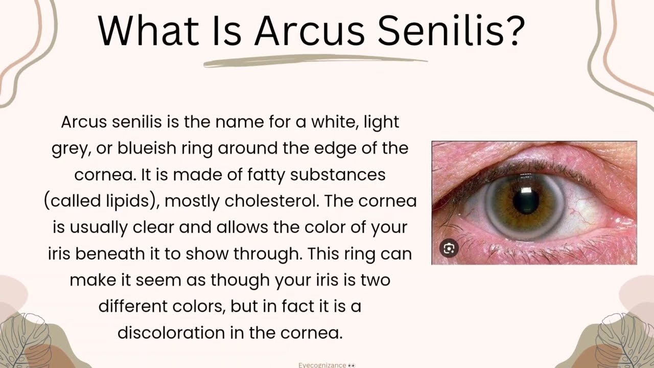 Arcus Senilis