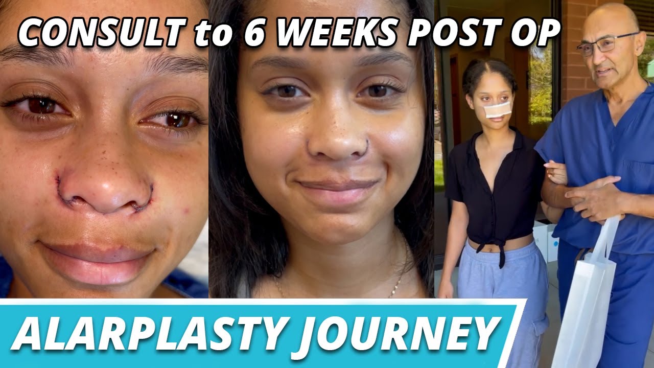 ALARPLASTY journey from surgery to 6 weeks POST OP #cosmeticsurgery ...