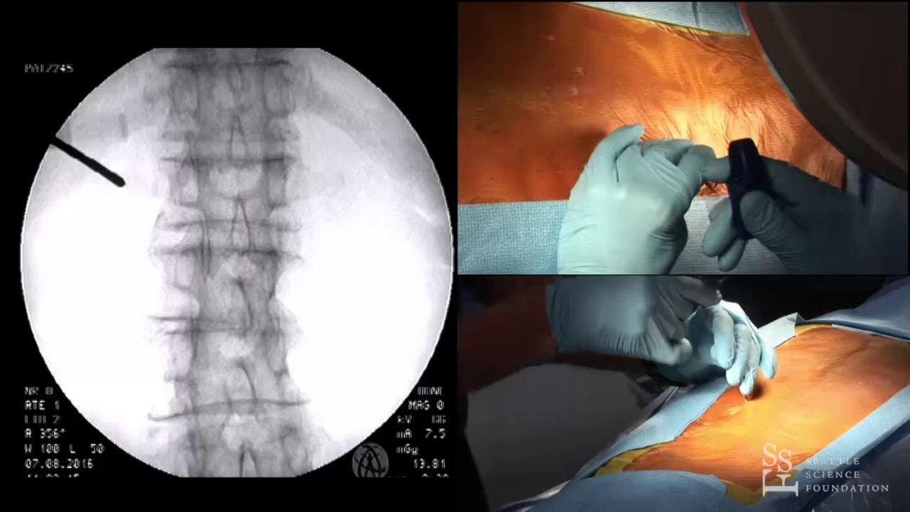 Vertebral Augmentation Lab Demo- Doug Beall, MD - YouTube