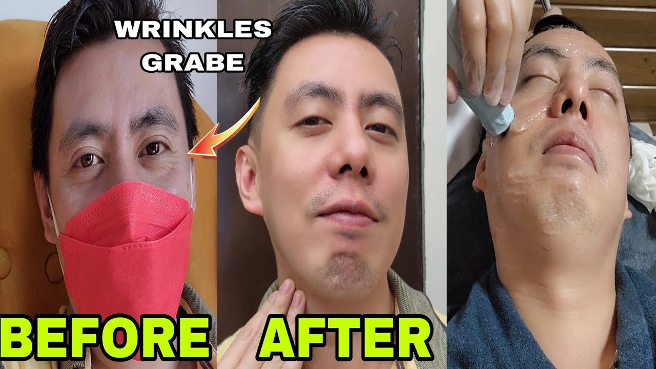 EXILIFT BEFORE & AFTER | 5x Better than HiFu Lifting & Tightening by ...