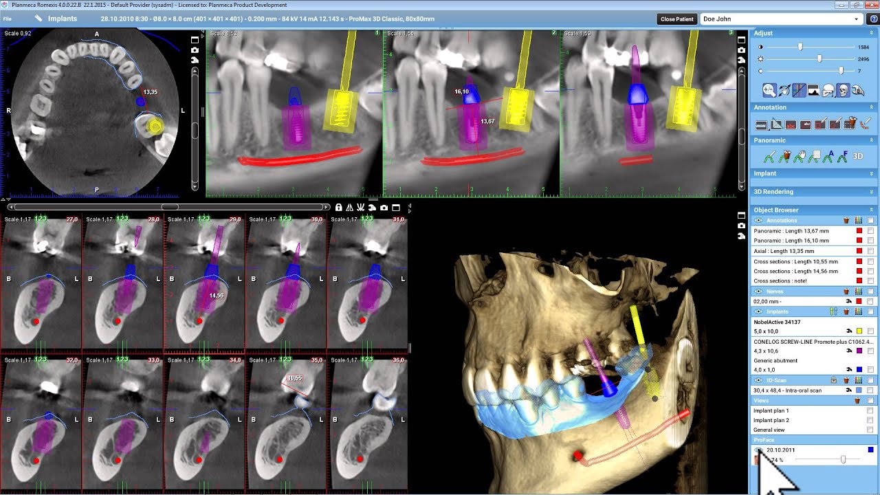 New Object Browser in 3D Module in Planmeca Romexis 4.0 - YouTube