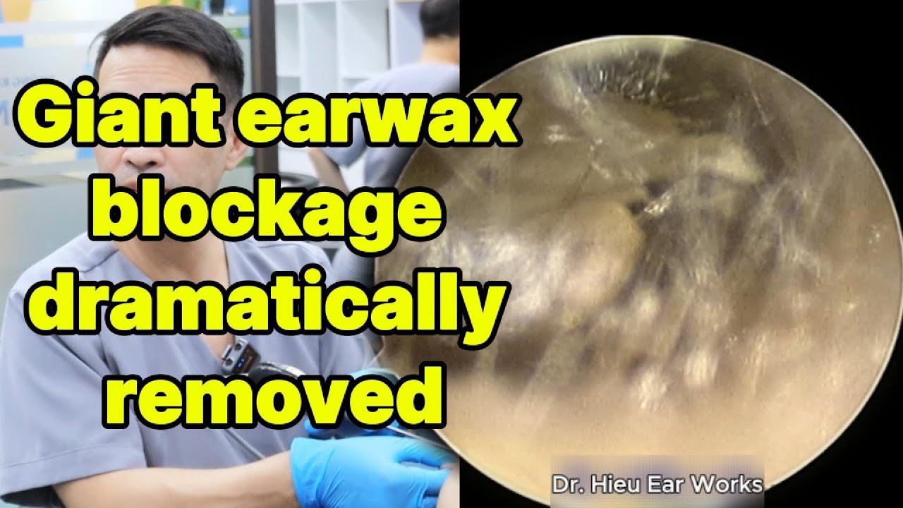 Giant earwax blockage dramatically removed | ear cleaning | ASMR earwax ...