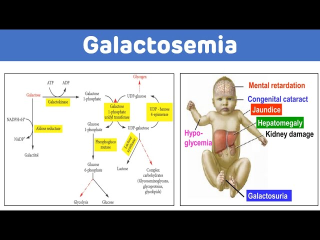 Sintomas De Galactosemia