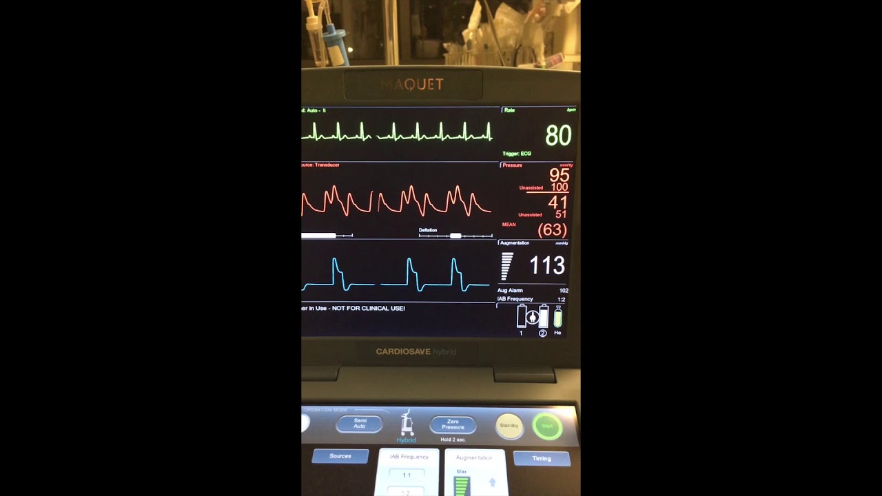 Intra Aortic Balloon Pump - YouTube