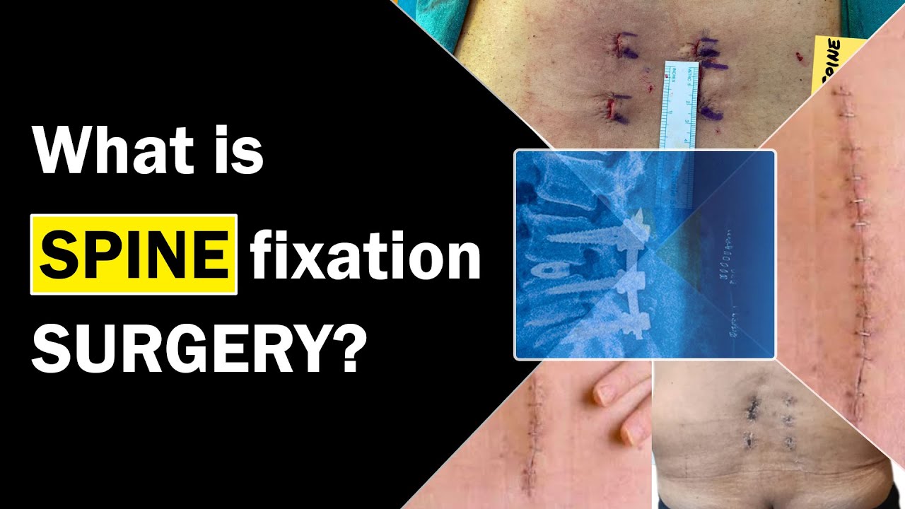 𝐖𝐡𝐚𝐭 𝐢𝐬 𝐬𝐩𝐢𝐧𝐞 𝐟𝐢𝐱𝐚𝐭𝐢𝐨𝐧 𝐬𝐮𝐫𝐠𝐞𝐫𝐲? 𝐃𝐫 𝐒𝐚𝐮𝐫𝐚𝐛𝐡 𝐊𝐚𝐩𝐨𝐨𝐫 𝐛𝐞𝐬𝐭 𝐬𝐩𝐢𝐧𝐞 𝐬𝐮𝐫𝐠𝐞𝐨𝐧 𝐢𝐧 ...