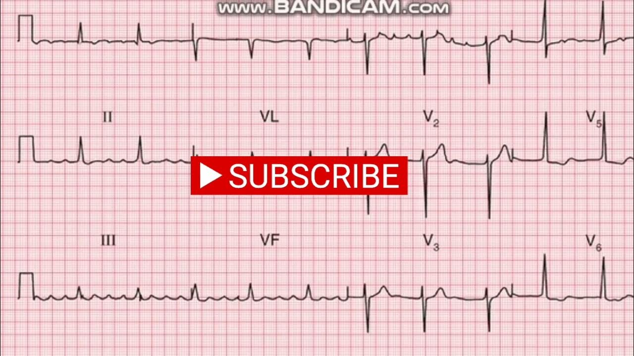 Atrial flutter - YouTube
