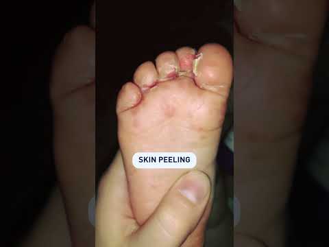 After Hand, Foot & Mouth Disease... #advice #baby #parentalcare #child #handfootmouthdisease