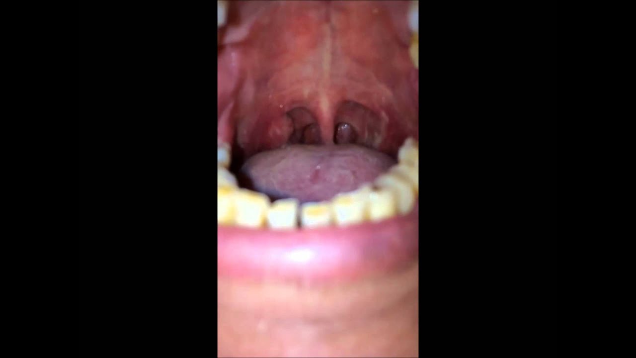 My dad's uvula - YouTube