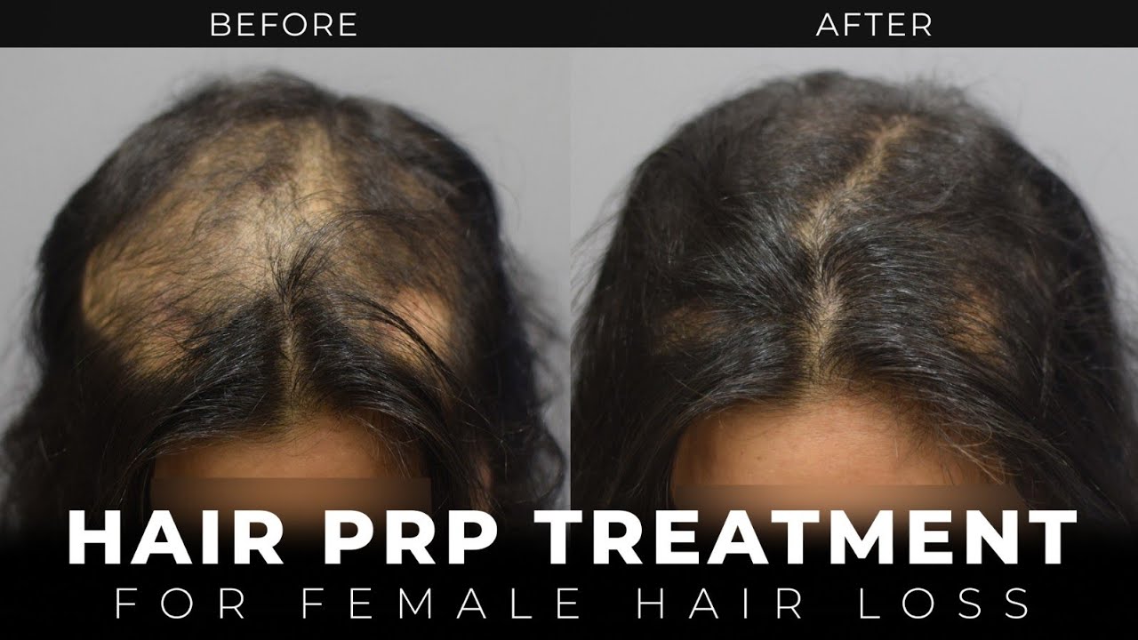 PRP Hair Treatment | Female Hair Loss | Trichotillomania Case Study - YouTube
