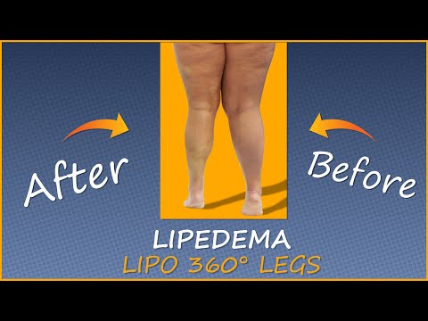 Lipedema Liposuction Surgery Results | Lipo 360° Legs | Cankles & Knees ...