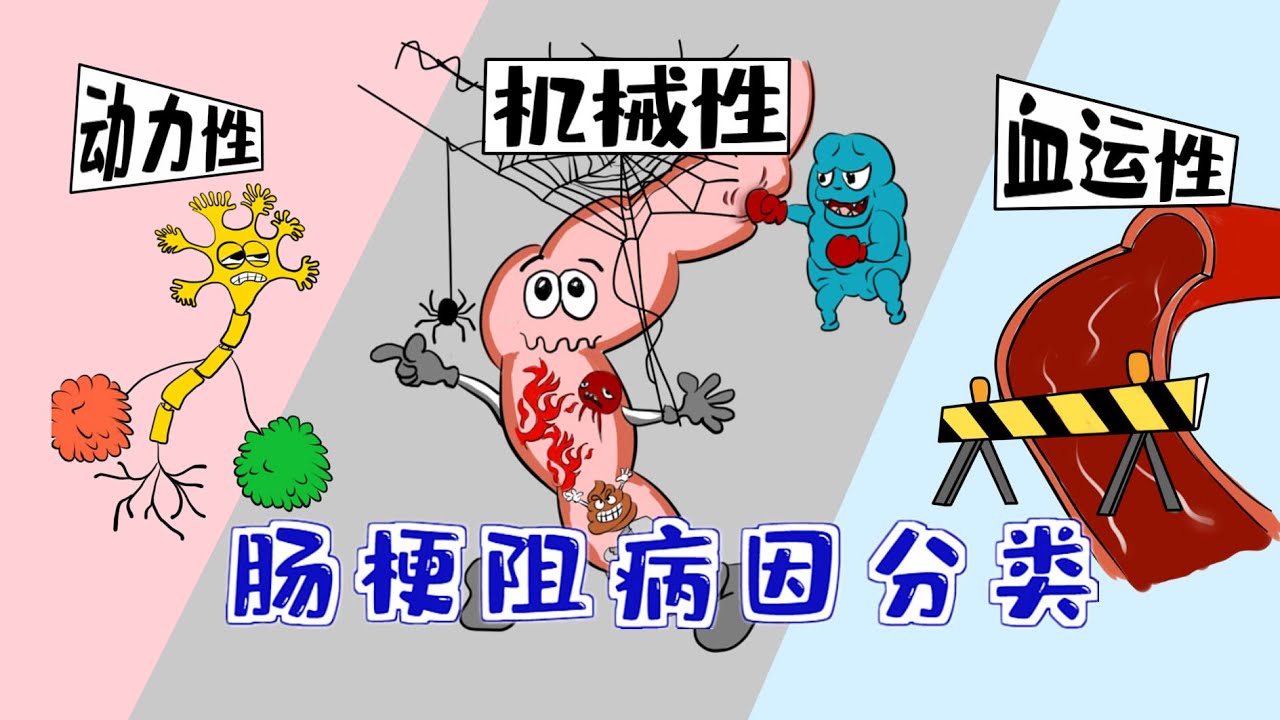 医学记忆漫画|【肠梗阻】病因和分类Medical Memory Comics|【Intestinal Obstruction】Causes ...