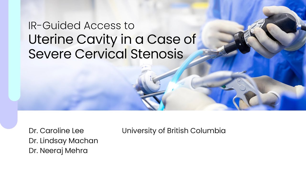 IR Guided Access to Uterine Cavity in a Case of Severe Cervical ...