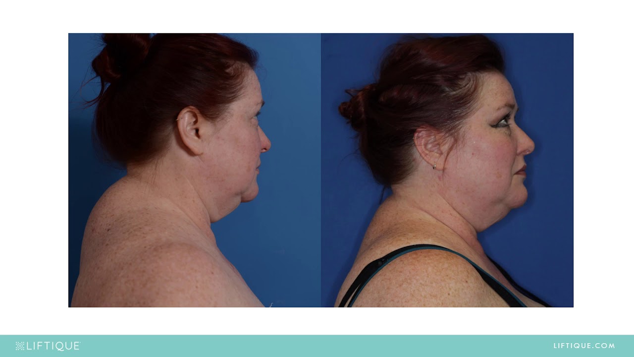 Liposuction: From Planning to Recovery - YouTube