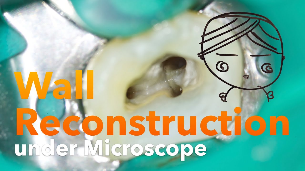 Wall Reconstruction with Flowable Resin under Microscope - YouTube