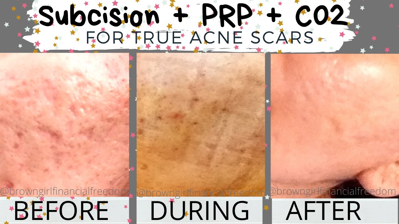 Subcision + PRP + Co2 Laser for True Acne Scars - YouTube