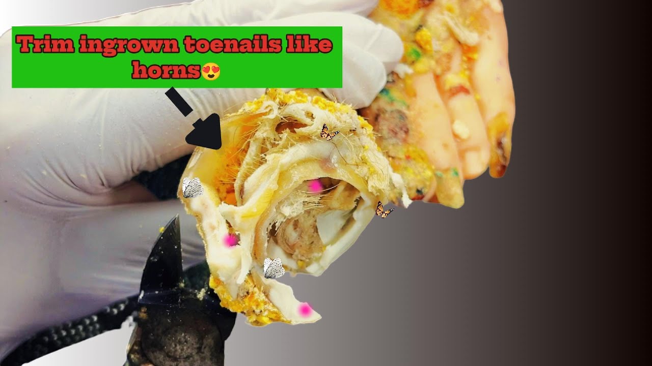 Trim ingrown toenails like horns😭 inverted toenails😭 toenail fungus ...
