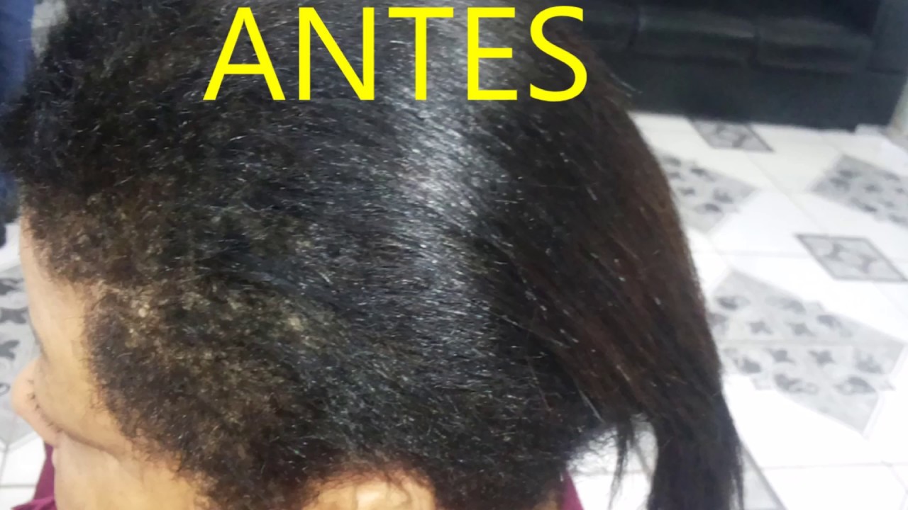 CORTE QUÍMICO, ANTES E DEPOIS ,COM TÉCNICA DE MICROLINK - YouTube