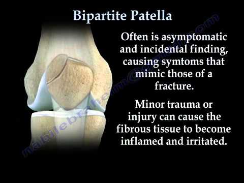 Bipartite Patella - YouTube