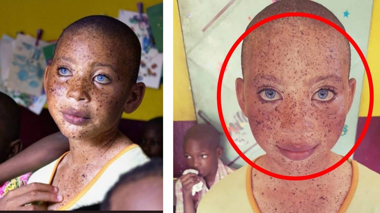 Mom Gives Birth To Rare child, Only 1 in million Known To Have Ever ...