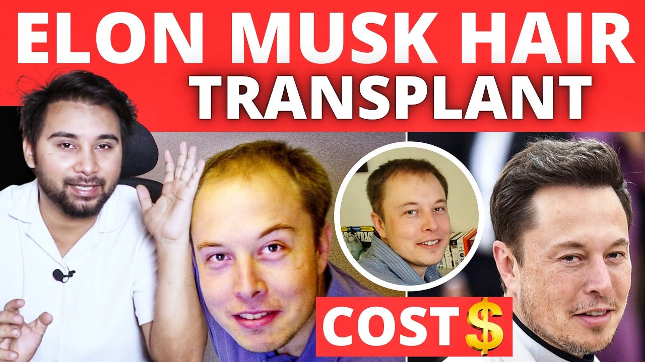 Elon Musk's Hair Transplant Cost Is Insane | Incredible Hair Transplant ...
