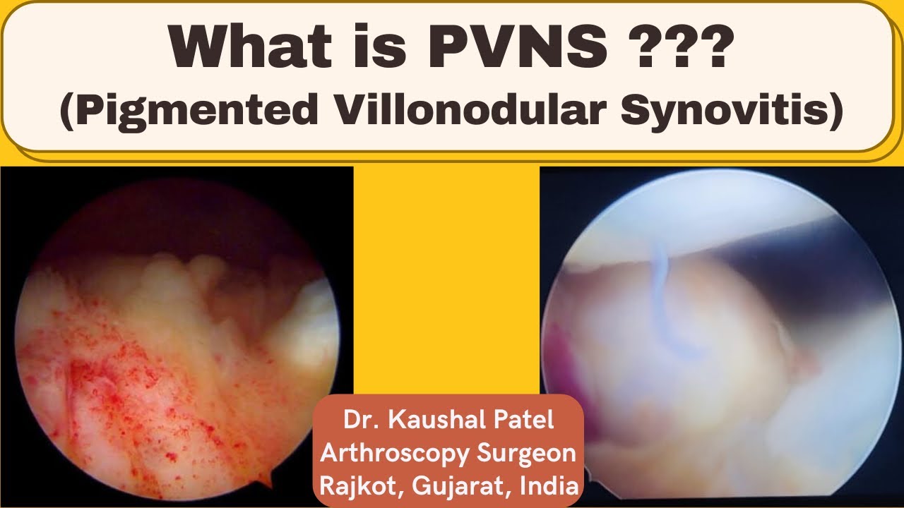 What is PVNS ? Pigmented Villonodular Synovitis | Diagnosis and ...