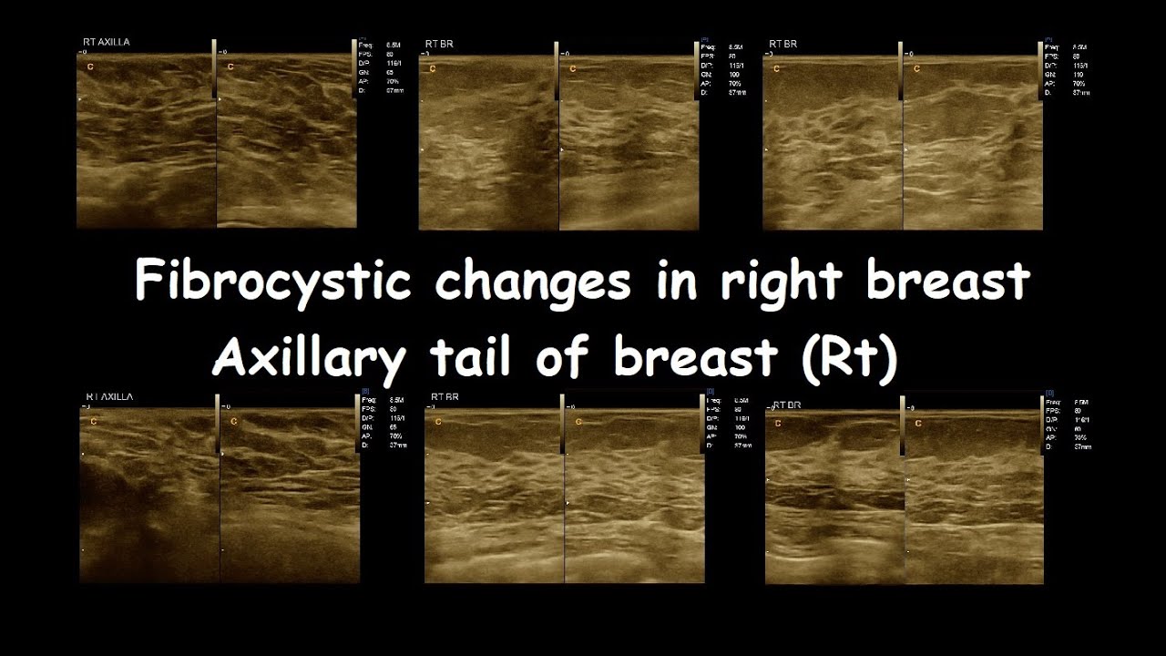 Fibrocystic Breast Disease | Axillary tail of right breast | Amader ...