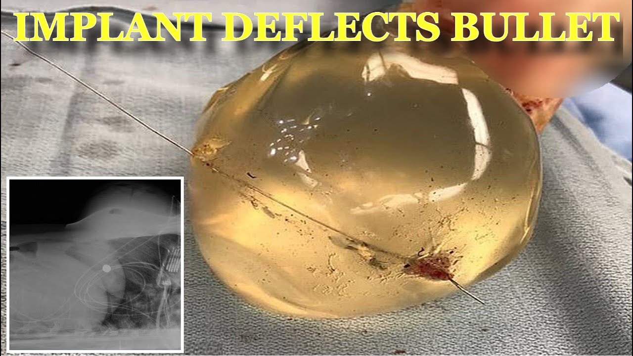 Implant Saved The Womans Life As Deflect The Bullet Away From Her