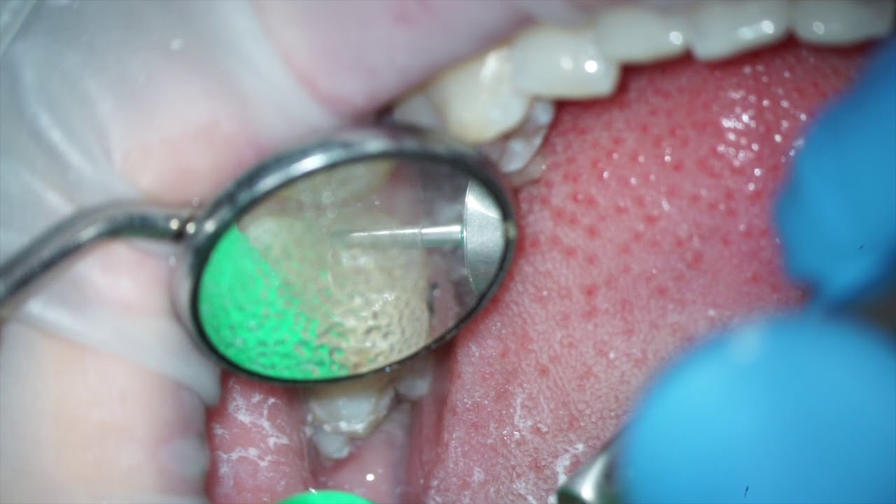 prep 26 composite overlay - YouTube