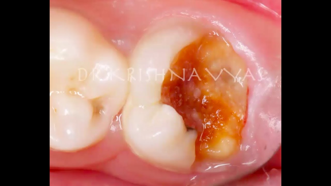 Badly mutilated teeth reinforcement with canal projection - YouTube