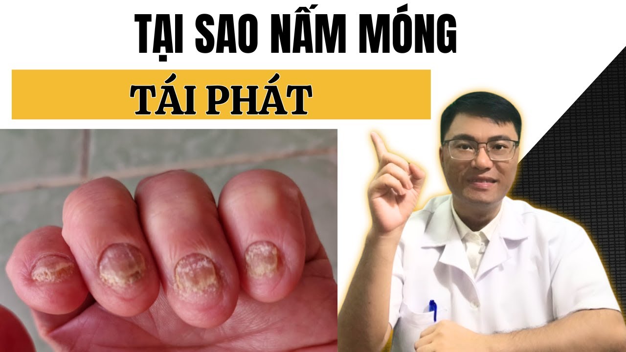 Tại Sao Nấm Móng Tái Phát Dù Bạn Đã Kiên Trì Bôi Thuốc Suốt Nhiều Tháng ...