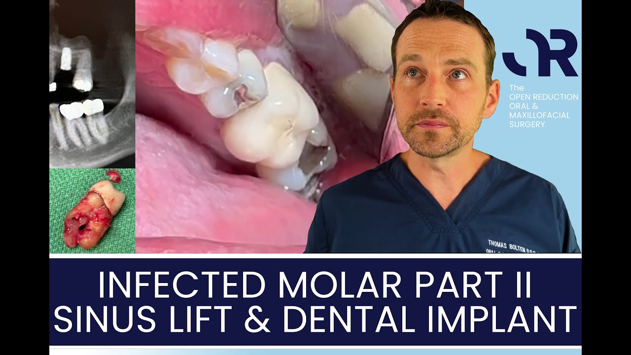 IMPLANT & SINUS LIFT after INFECTED TOOTH REMOVED - YouTube