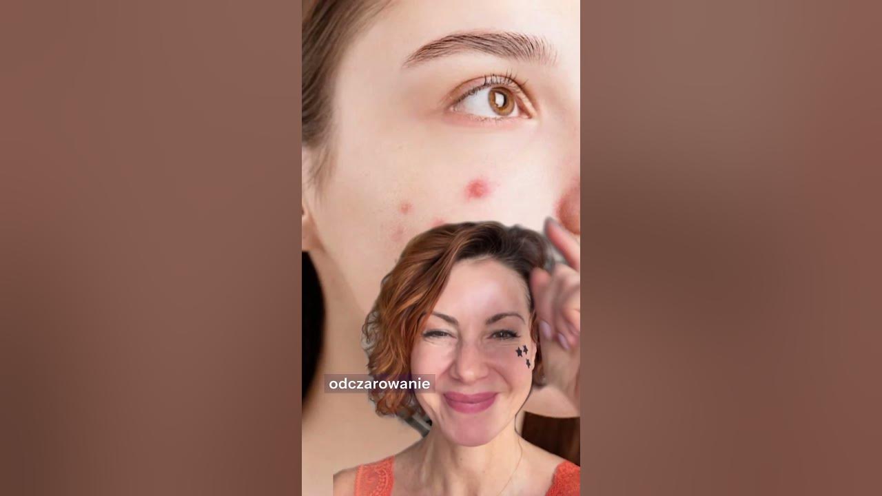 JAK ZLIKWIDOWAĆ WYPRYSKI? Jest taki jeden preparat, który robi to mistrzowsko… - YouTube