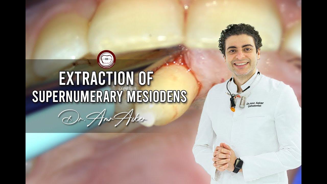 Extraction of supernumerary mesiodens in orthodontics - YouTube