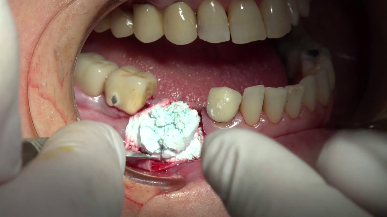 Extraction, Implant placement and augmentation using Augma's Bond ...