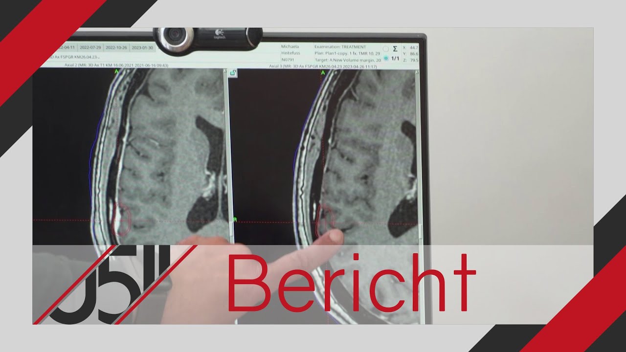 Hirntumore präzise bestrahlen: Gamma Knife-Therapie - YouTube