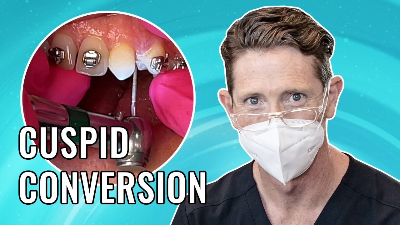 Cuspid Conversion - YouTube