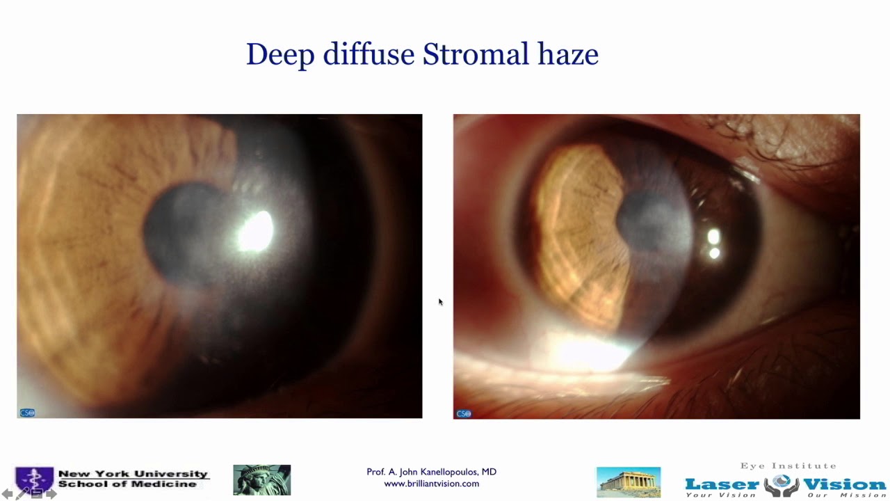 Crosslinking Essentials - Crazy Complications and How to Manage - YouTube