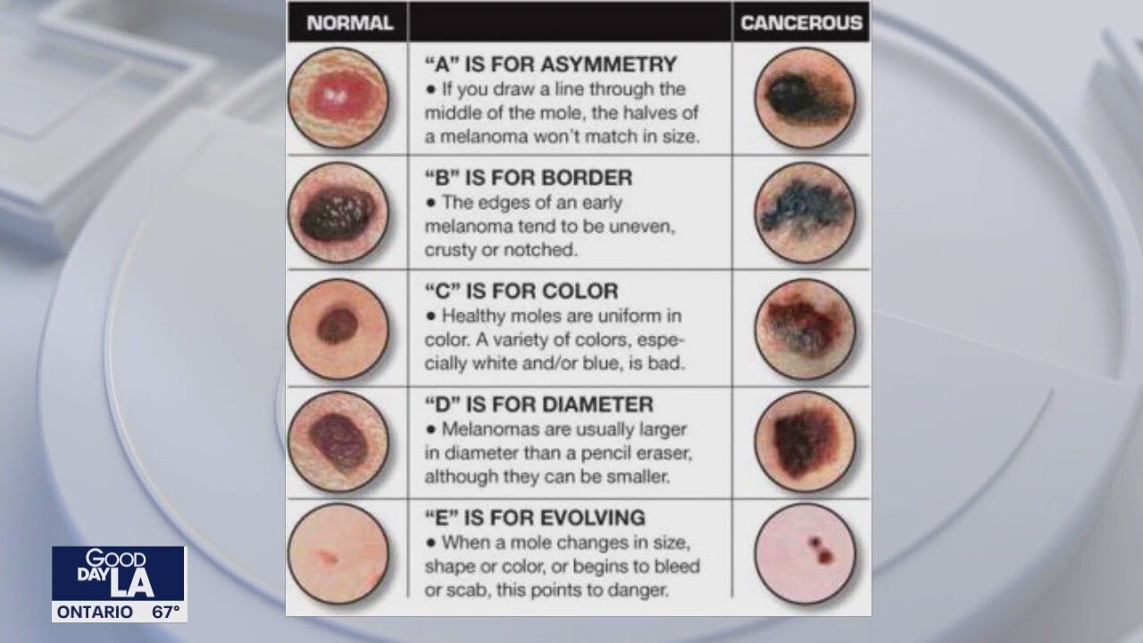 Skin cancer prevention: Mole checks - YouTube