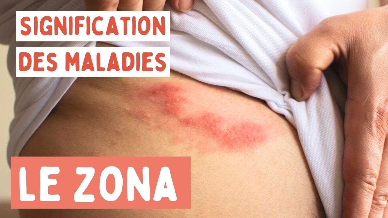 SIGNIFICATION DES MALADIES : LE ZONA 🔍 - YouTube
