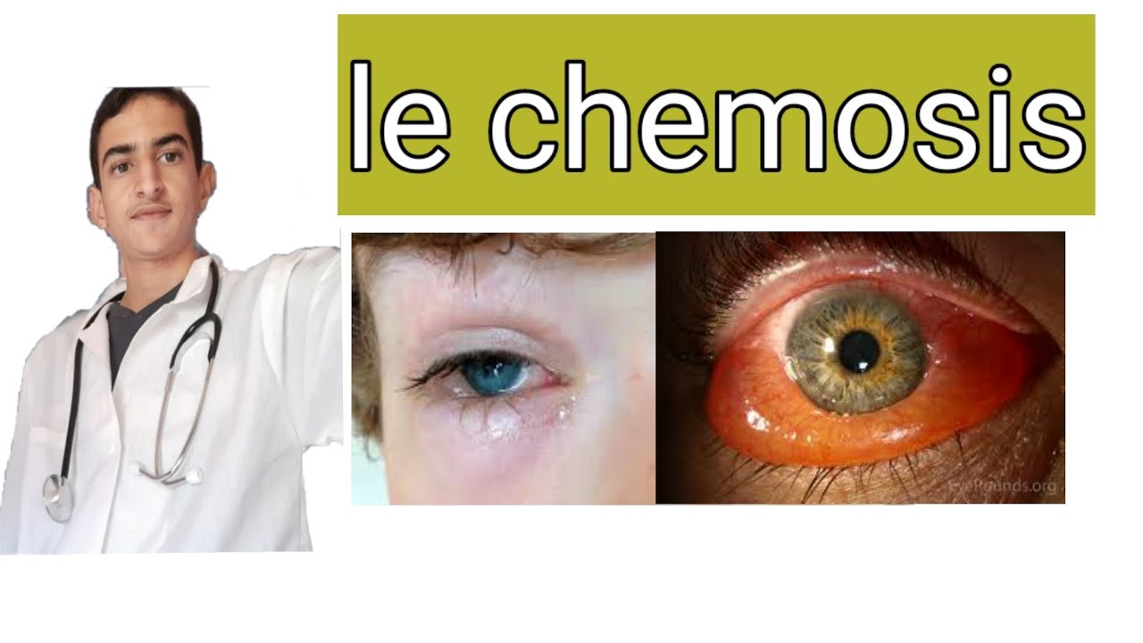 le chémosis - YouTube