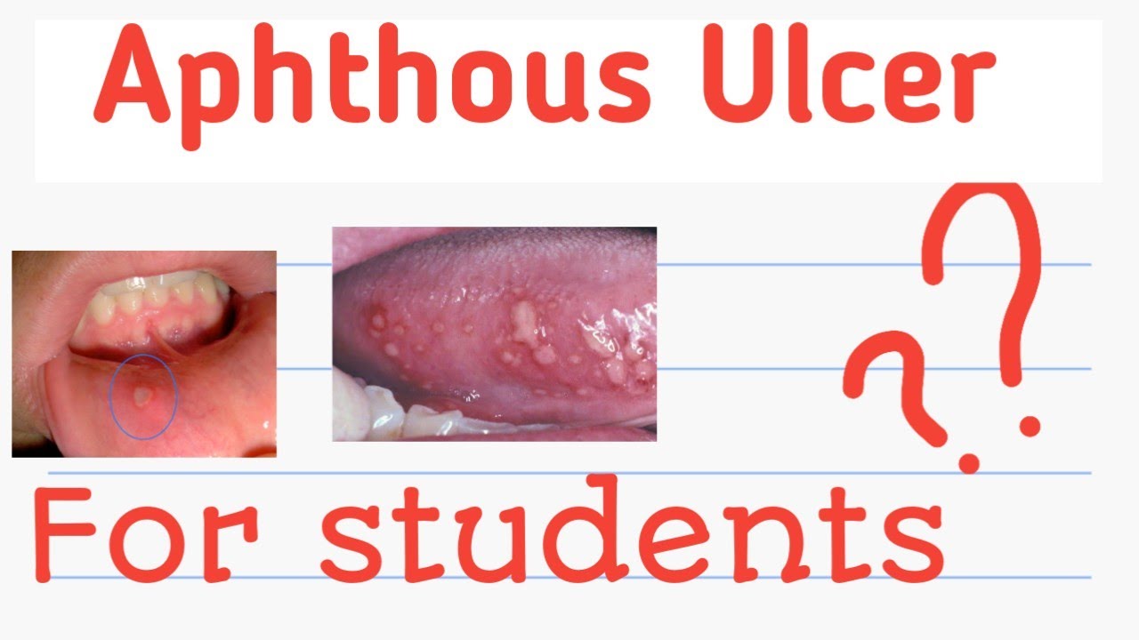Aphthous Ulcer Details | Oral Pathology | Oral Medicine | Cause ...